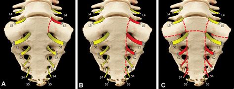 Sacral Fracture Grading At Jenenge Blog