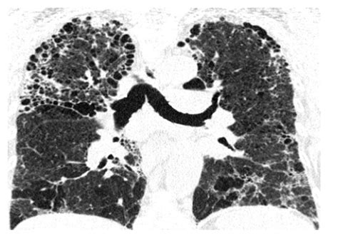 Clinical Radiological And Functional Profile Of Patients With Diffuse