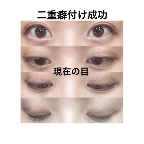 目 二重 自力
