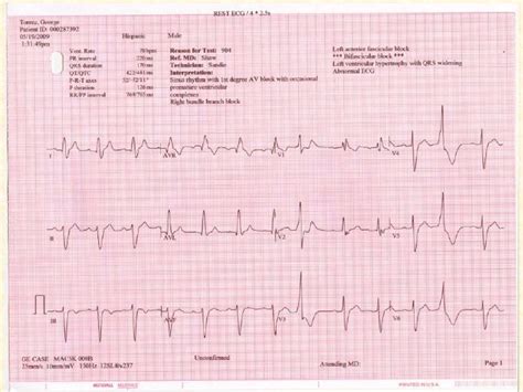 Trifascicular Block Presentation