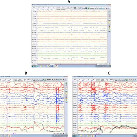 Interictal Eeg Revealed Sharp Waves Detected In The Right Anterior Download Scientific Diagram
