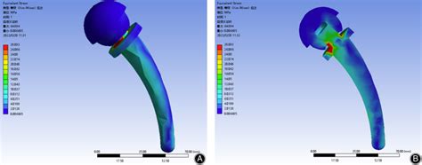 The Von Mises Stress Distribution Of Cfp Prosthesis Fea Model A Download Scientific Diagram