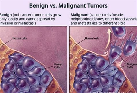 Benign Tumor Diagram