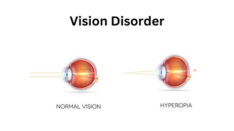 What Is Farsightedness Hyperopia