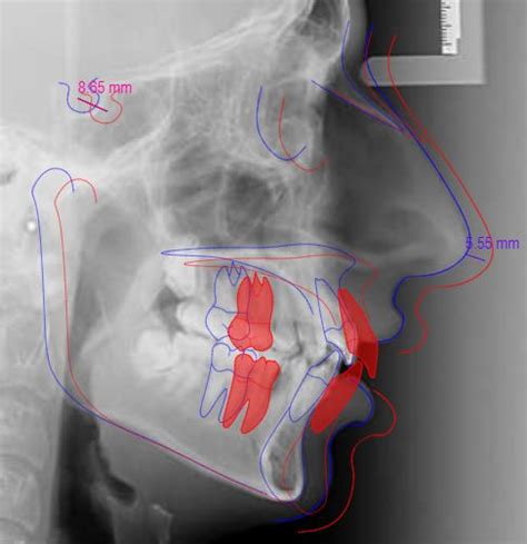 Ai Services Automatic Cephalometric Analysis Cephx