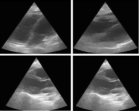 Echocardiogram Showing Areas Of Regional Wall Motion Abnormalities Download Scientific Diagram