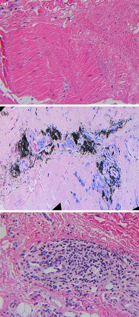 Strong Cord Of Fibrous Connective Tissue At Maddison Koerstz Blog