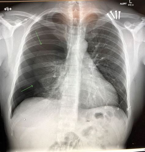 How To Identify A Collapsed Lung At Gemma Adcock Blog
