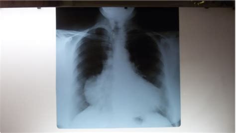 Chest X Ray Shows Widened Mediastinum Download Scientific Diagram