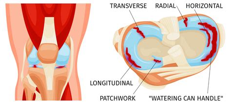 Comprehensive Meniscus Tear Surgery In Montreal Trusted Surgeons