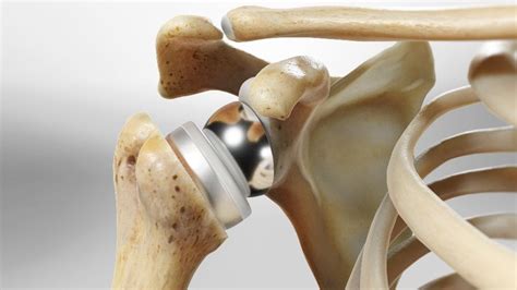 Shoulder Replacement Post Operative Instructions Aptiva Health