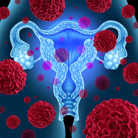 Ovarian Cancer Parp Inhibitors Success Depend On Location Of Gene