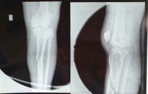 真实案例一遇到粉碎性骨折怎么办看大家医联霸州医院如何化解 患者