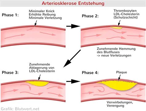 Arteriosklerose Ursachen Folgen Risiken Einfach Erklärt