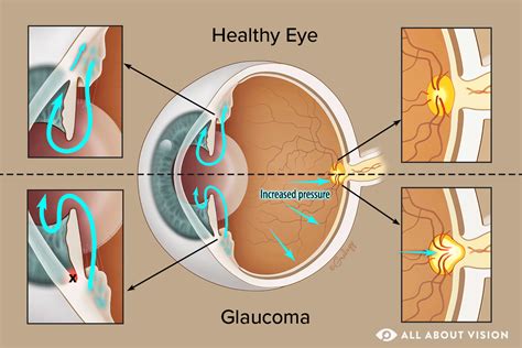 Glaucoma Eye Test
