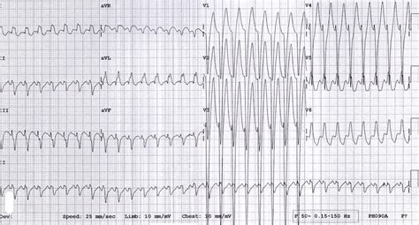 Pediatric Svt Ecg