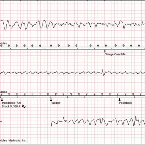 Case 8 Double External Sequential Defibrillation Shock 5 56 Minutes Download Scientific