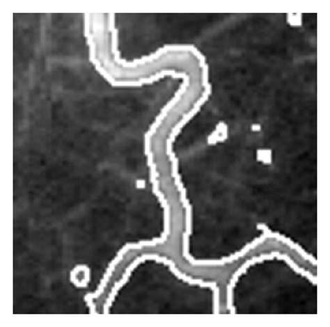 Level Set Segmentation Of The Ct Vessel By Various Initializations Download Scientific Diagram