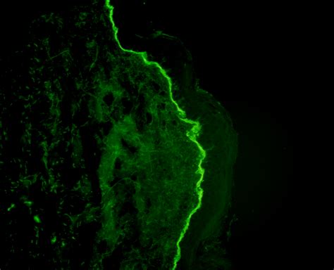 Direct Immunofluorescence Study Reveals Deposition Of Ig A In Linear