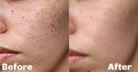 Goodbye Expensive Products Best Remedy To Get Rid Of Large Pores Glowpink