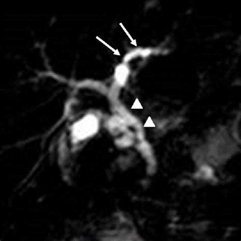 Magnetic Resonance Imaging With Magnetic Resonance Cholangiography Download Scientific Diagram
