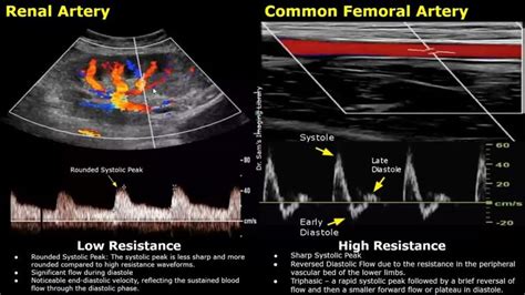 Difference Between Low Resistance And High Resistance Waveforms On Spectral Doppler Ultrasound Usg