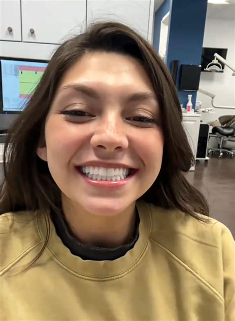 After Having All Her Teeth Pulled Out At 20 Woman Shares “beforeafter