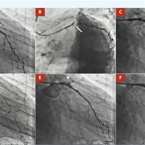 A Rao 25° Cau 25° Total Proximal Occlusion Of The Anterior Download Scientific Diagram