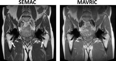 The Role Of Advanced Metal Artifact Reduction Mri In The Diagnosis Of Periprosthetic Joint