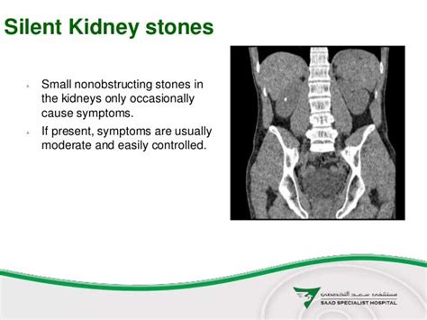 Urolithiasis Urinary Stones Disease Presentation