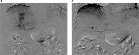 Digital Subtraction Angiography DSA Before And After Surgery A DSA Download Scientific