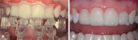Contouring And Polishing Anterior Composite Restorations Created With
