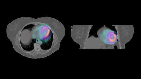 Spectct Overcomes Breast Attenuation Artifact For Improved Specificity