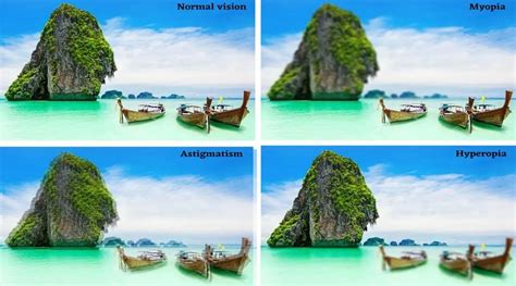 A Clearer Vision Of Myopia Hyperopia And Astigmatism