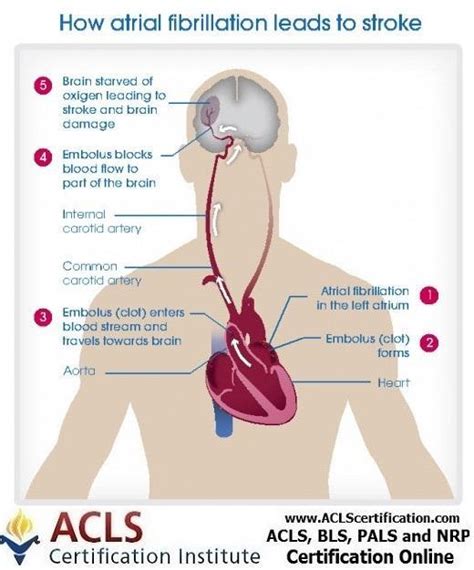 Atrial Fibrillation Leading To Stroke