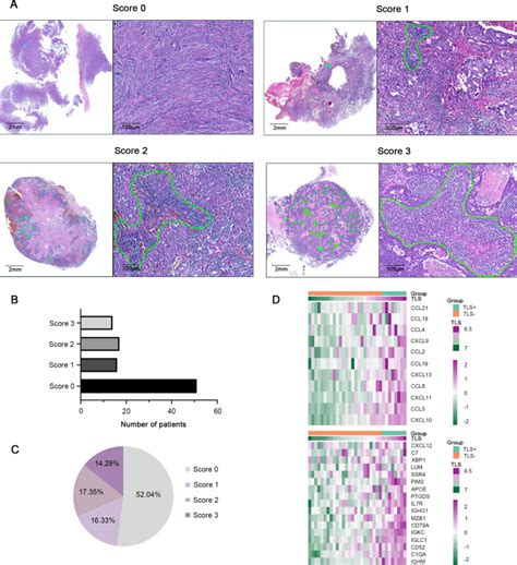 Density Of Tertiary Lymphoid Structures Predicts Clinical Outcome In Breast Cancer Brain