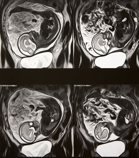 Mri Improves Diagnostic Accuracy Of Fetal Brain Abnormalities