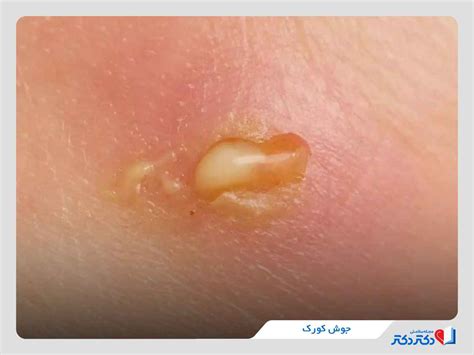 انواع بیماری های پوستی معرفی 21 بیماری شایع پوستی