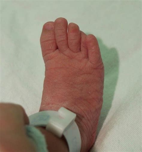 Overlapping Toe Newborn Health Newborn Assessment Neonatal