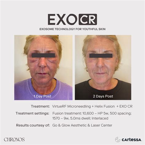 Rejuvenation With Exosome Bare Skin And Laser