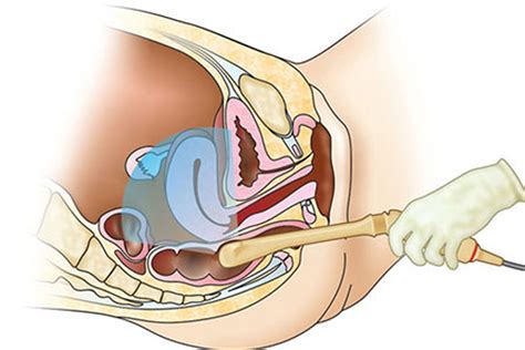 Transvaginaltransrectal Usg Sonography
