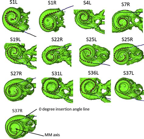 Composite Ct Volumes Including Electrode Array For Individual Ears For Download Scientific