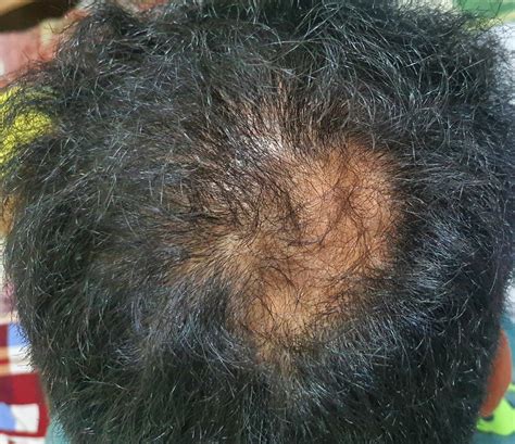 Diffuse Balding On Top And Back Of Head Rtressless