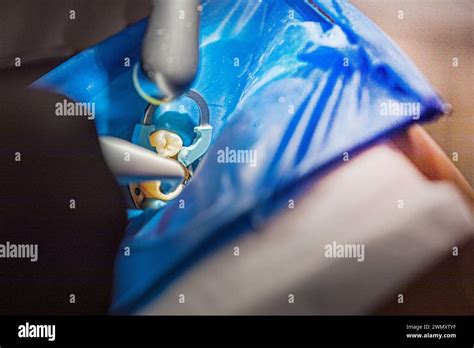 Dentist Inserts A Dental Instrument Between The Patients Teeth Dental Care And Health Stock