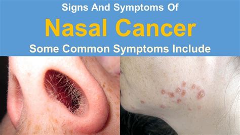 Nasal Polyps Nasal Polyps Cancer Symptoms Diagnosis And Treatment