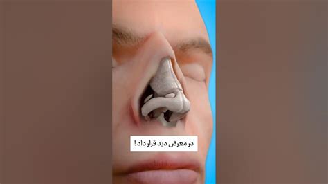 کیا میخواستن عمل بینی رو ببین چجوریه🫣 Youtube
