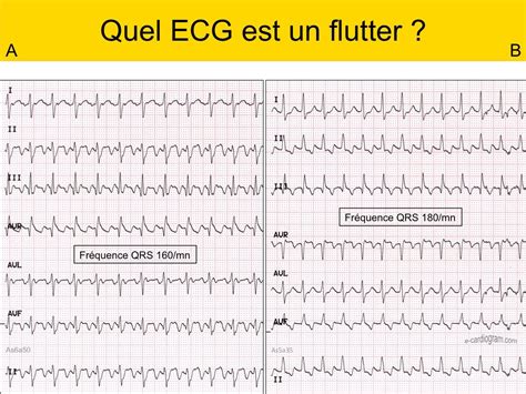 Ecg Normal E Cardiogram