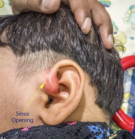 A Hole Near The Ear Aka Preauricular Sinus The Gentle Surgeon