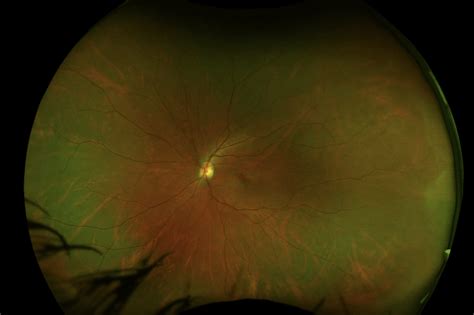 Optometry Dx Predict Progression On The Pachychoroid Spectrum Optometry Advisor