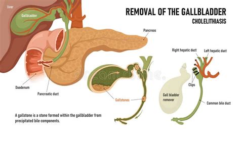 Cholecystitis Inflammation Of The Gallbladder And Bile Ducts Removal